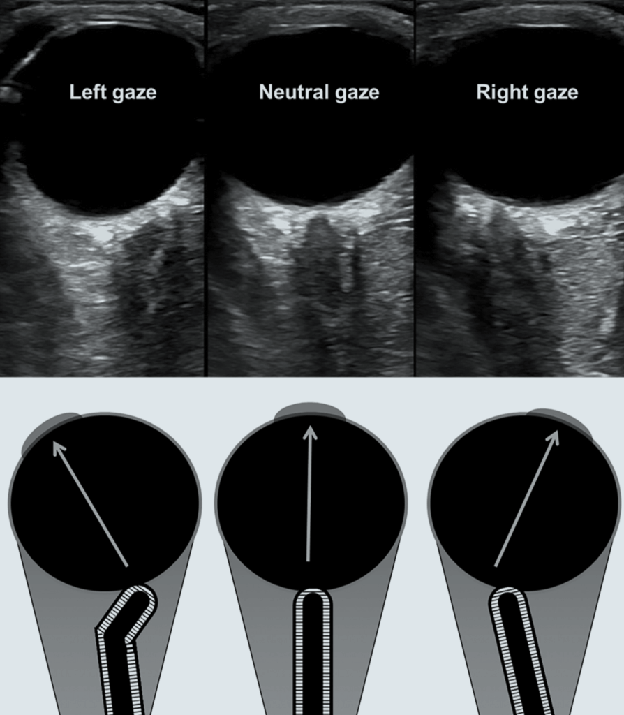 Ultrasonographic optic nerve sheath diameter technical pitfalls and ...